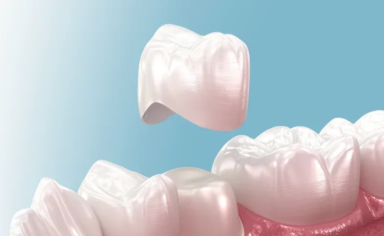 Dental Crowns in Suwanee, GA | Center for Advanced Dentistry